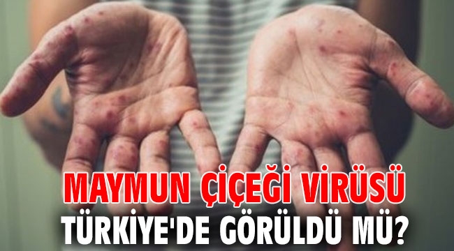 Maymun Çiçeği virüsü Türkiye'de görüldü mü? - GÜNDEM - Manşet İzmir